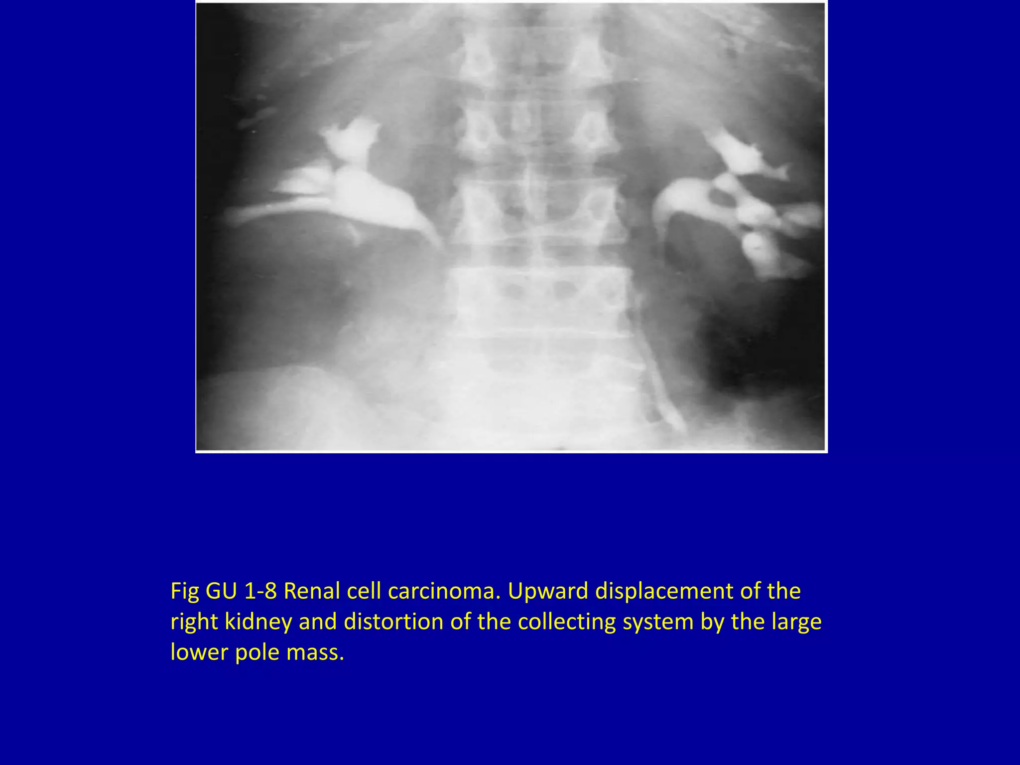 1 misplaced, displaced, or absent kidney | PPTX