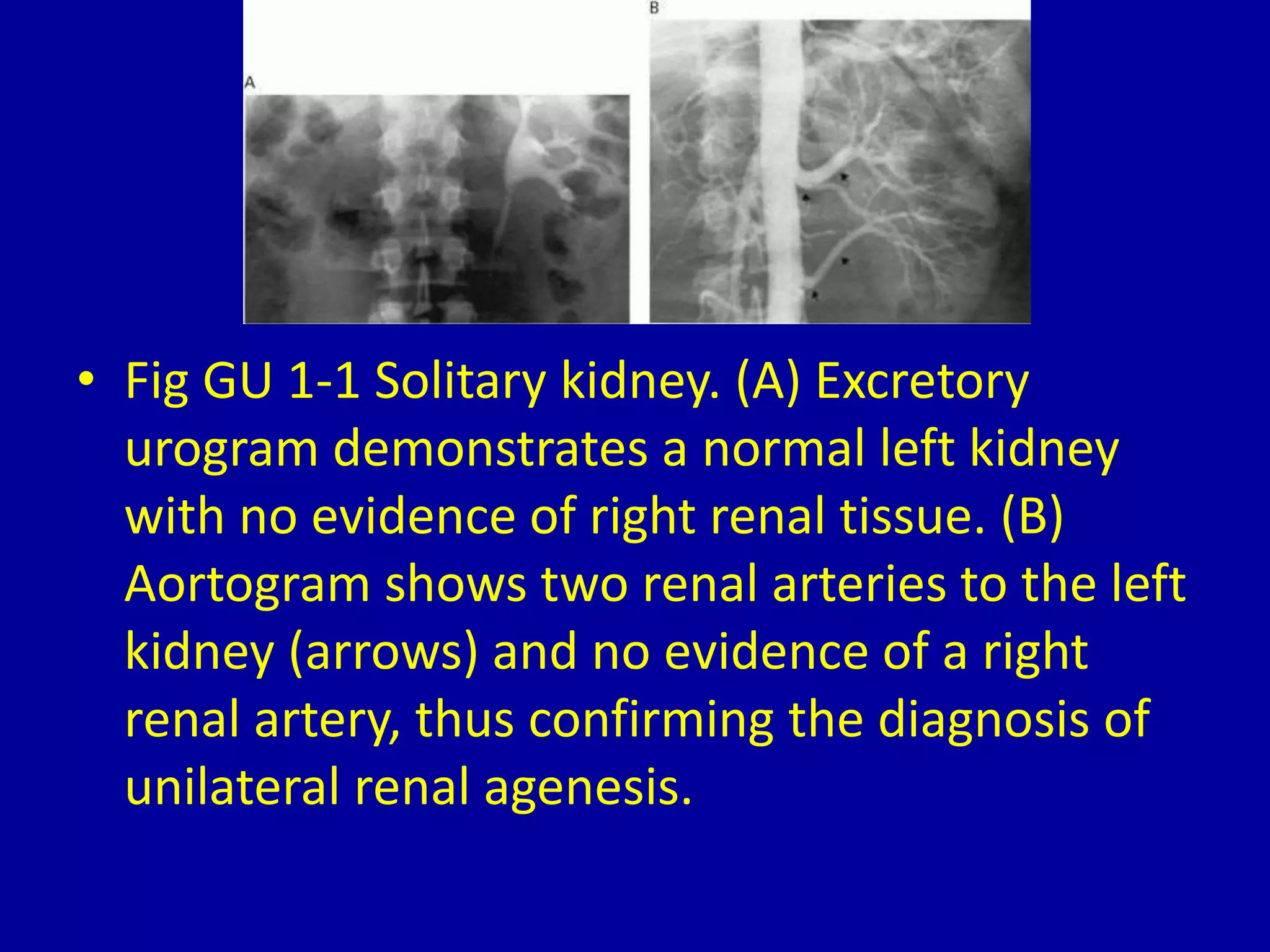 1 misplaced, displaced, or absent kidney | PPTX