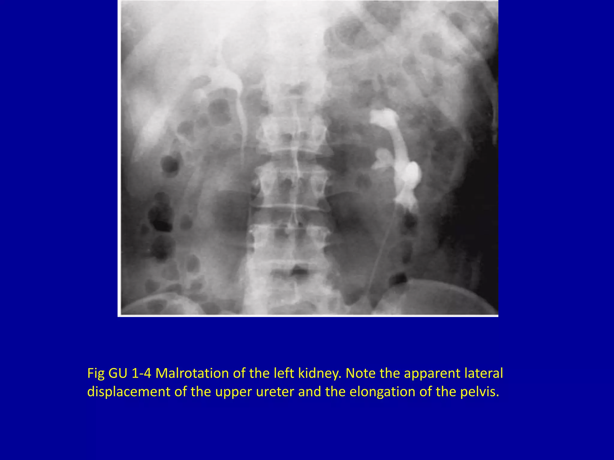 1 misplaced, displaced, or absent kidney | PPTX