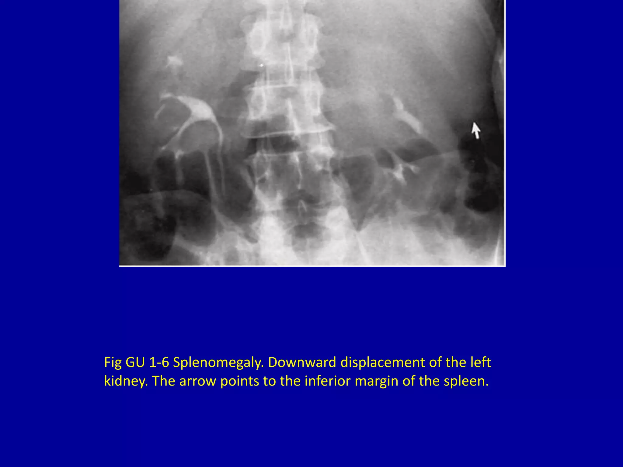 1 misplaced, displaced, or absent kidney | PPTX