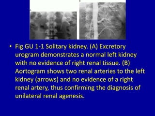 1 misplaced, displaced, or absent kidney | PPT