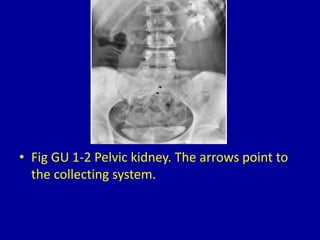 1 misplaced, displaced, or absent kidney | PPT