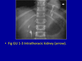 1 misplaced, displaced, or absent kidney | PPT