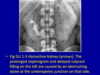 1 misplaced, displaced, or absent kidney | PPTX