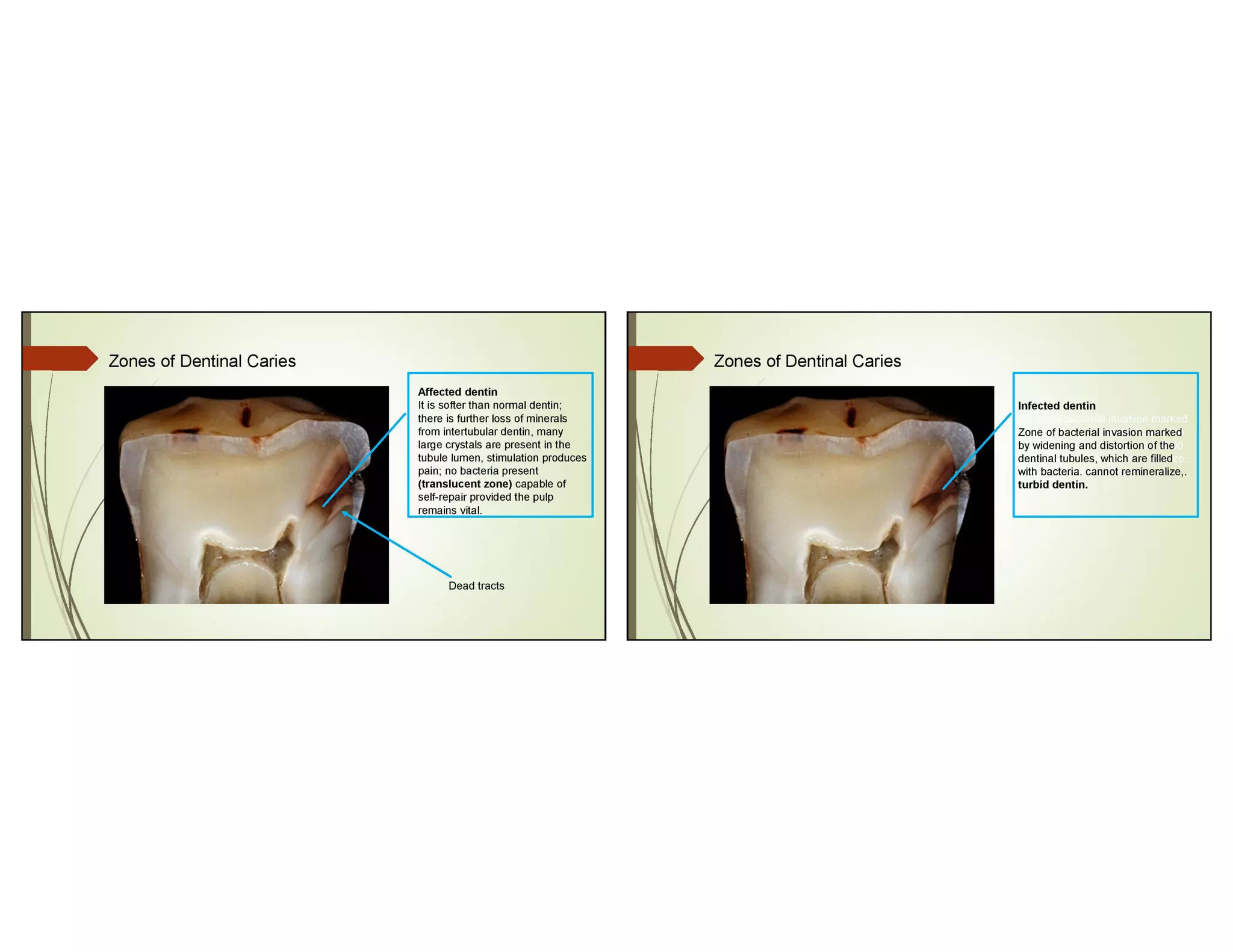 1_Module_1__Introduction_to_Cariology_The_Dental_Caries_Process_and_its ...