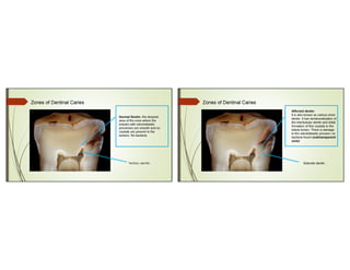 1_Module_1__Introduction_to_Cariology_The_Dental_Caries_Process_and_its ...