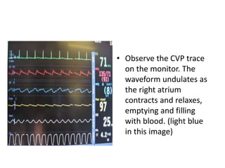 1 Monitoring of Central Venous Pressure & Its Techniques | PPTX