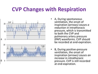 1 Monitoring of Central Venous Pressure & Its Techniques | PPTX