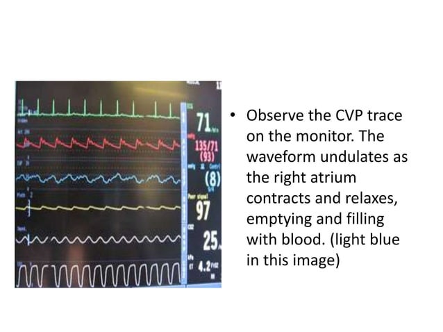 1 Monitoring of Central Venous Pressure & Its Techniques | PPT