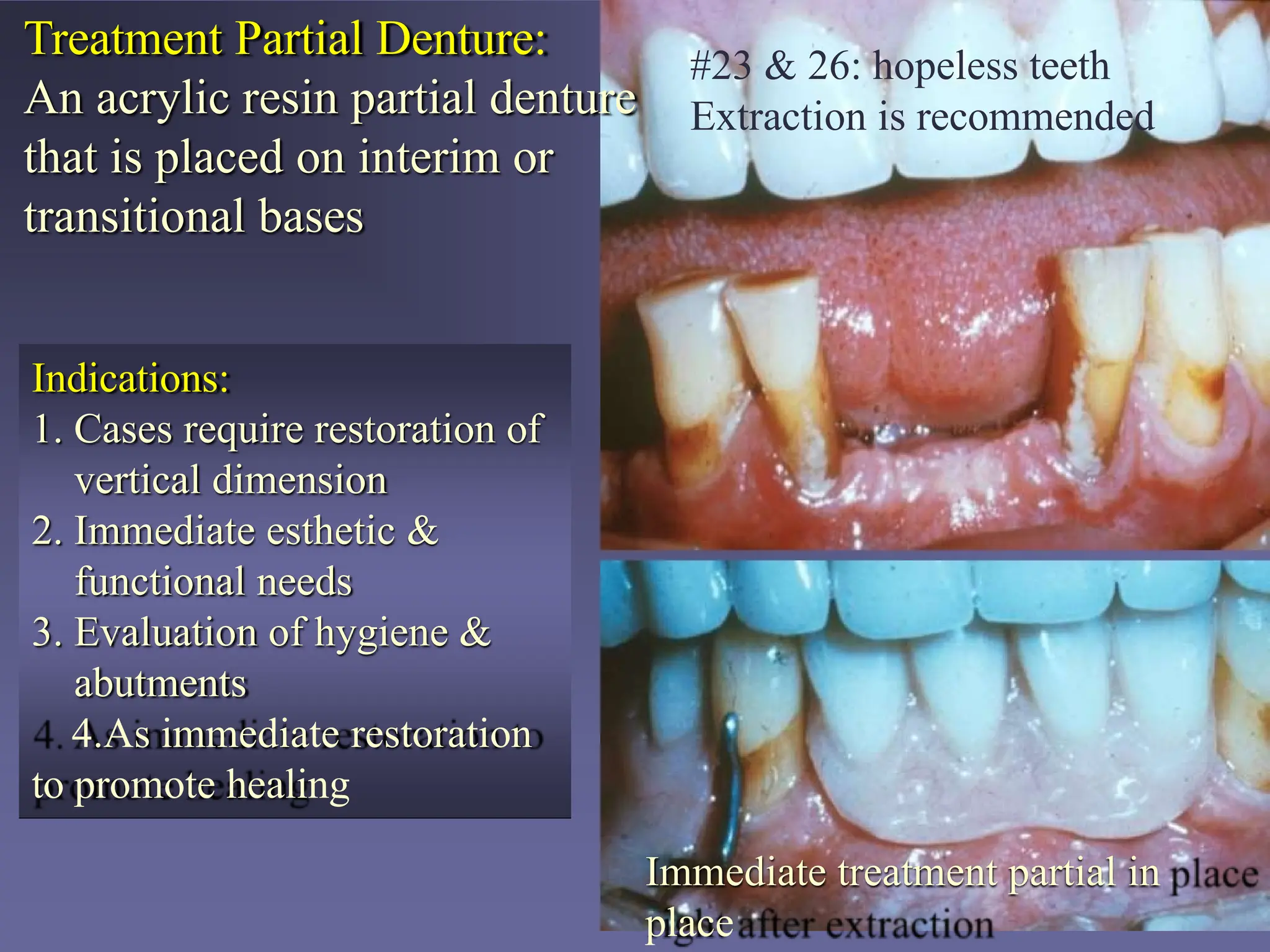 (1)Mouth preparation for removable partial denture march 2020 ppt.pptx