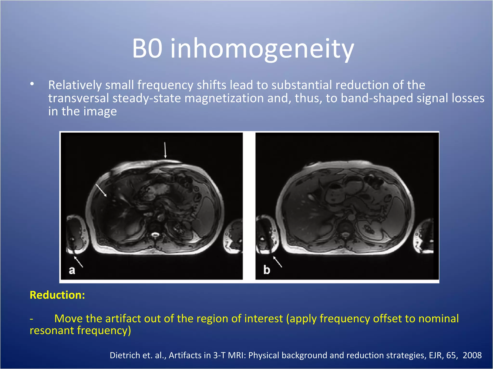 Distortion Artifacts in MRI and their correction | PPT