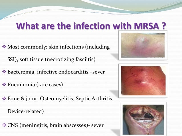 Understanding MRSA