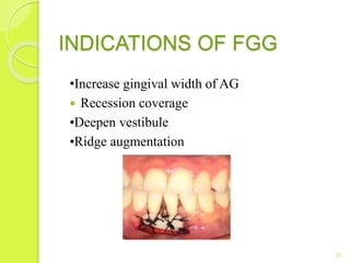 Mucogingival Surgery | PPT