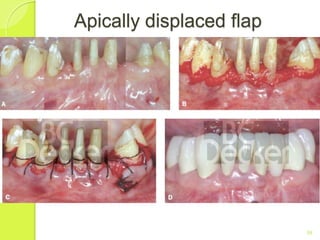 Mucogingival Surgery | PPT