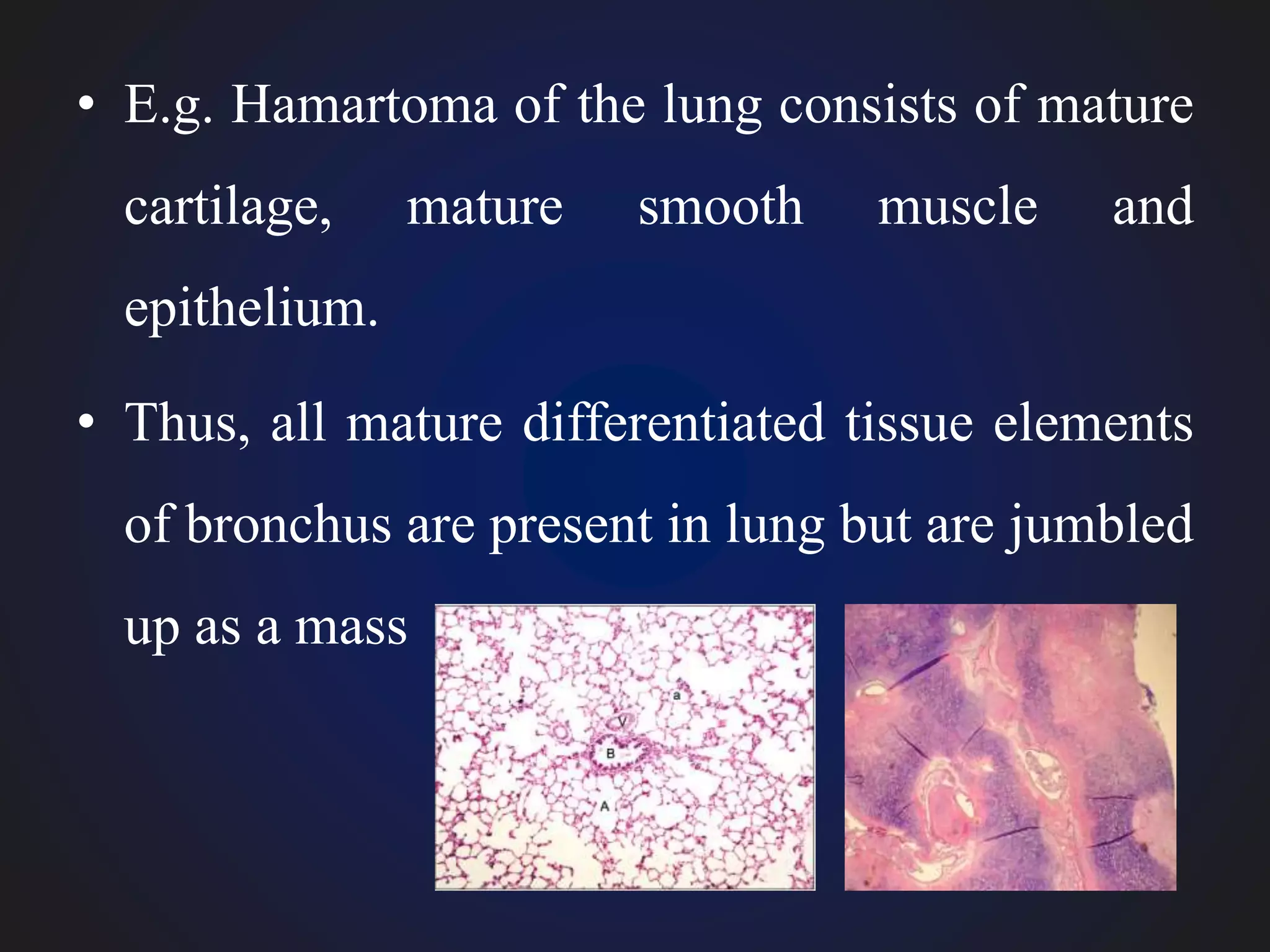 neoplasia introduction, nomenclature, classification of tumours | PPTX