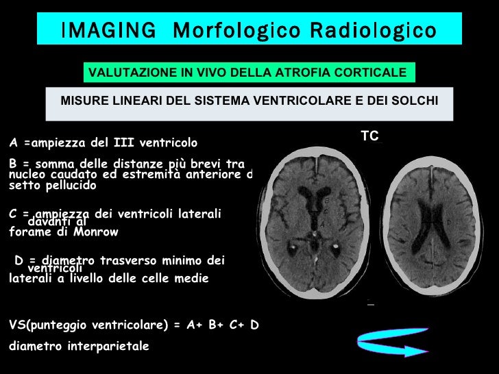 neuroimaging nelle demenze