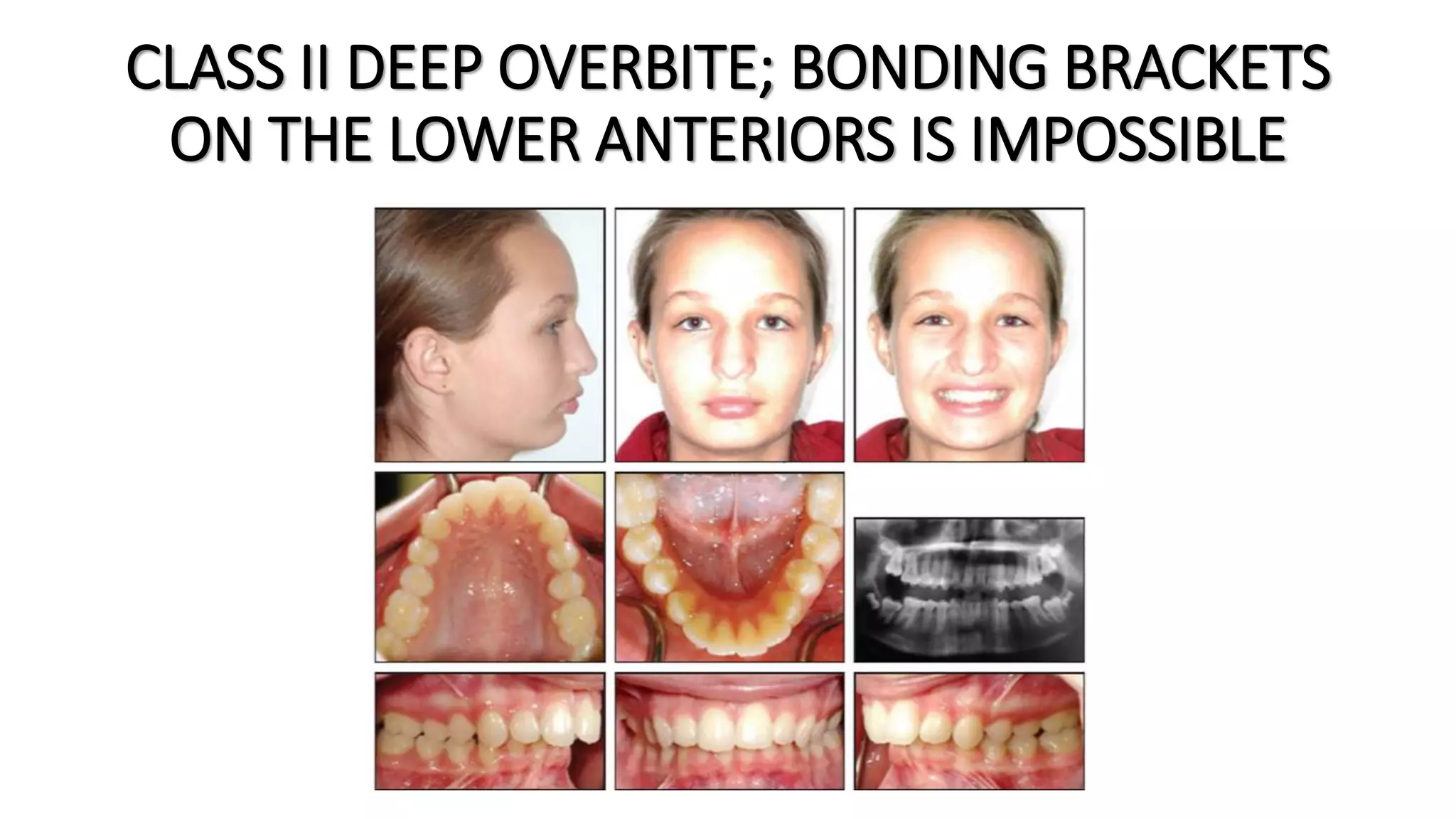 1 opening the bite with bite turbo | PPTX