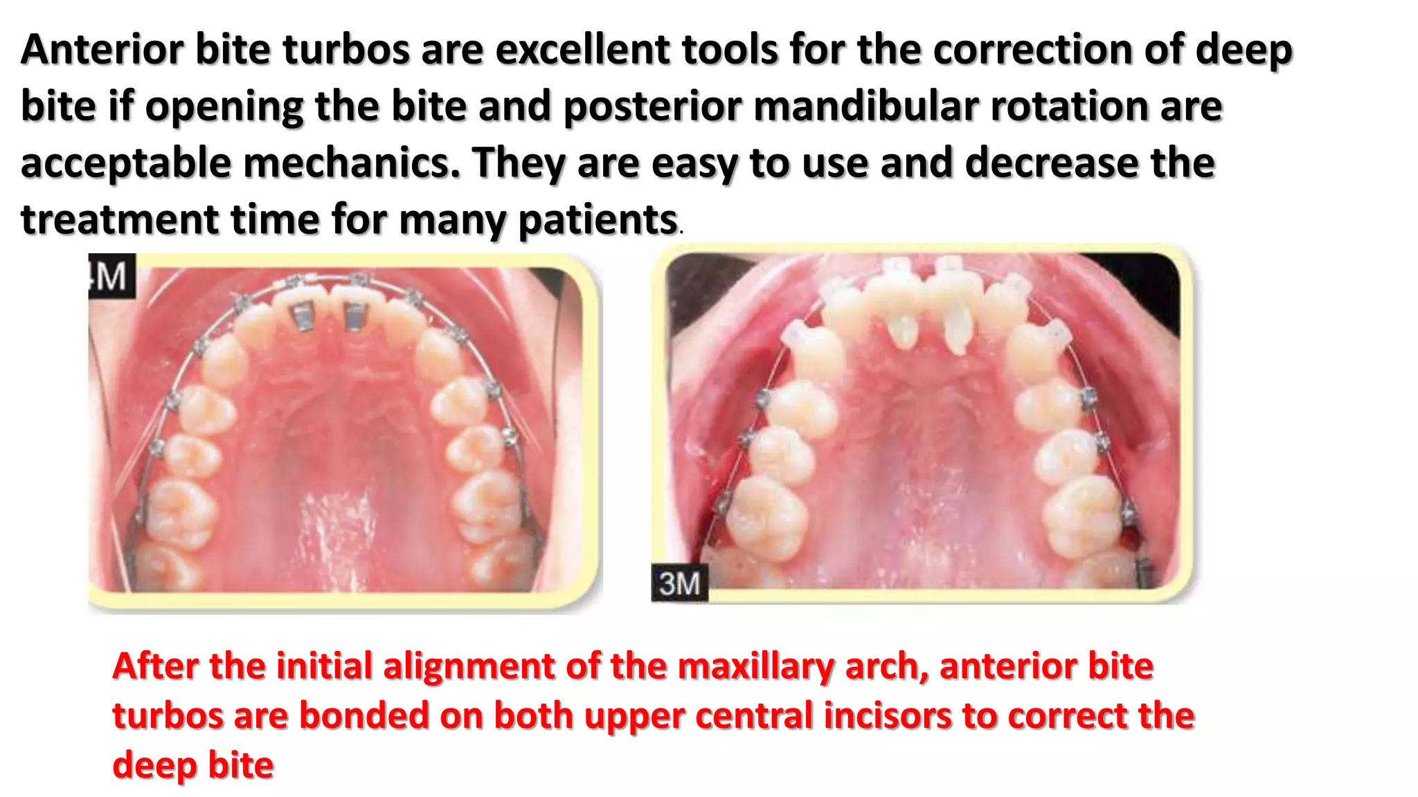 1 opening the bite with bite turbo | PPTX