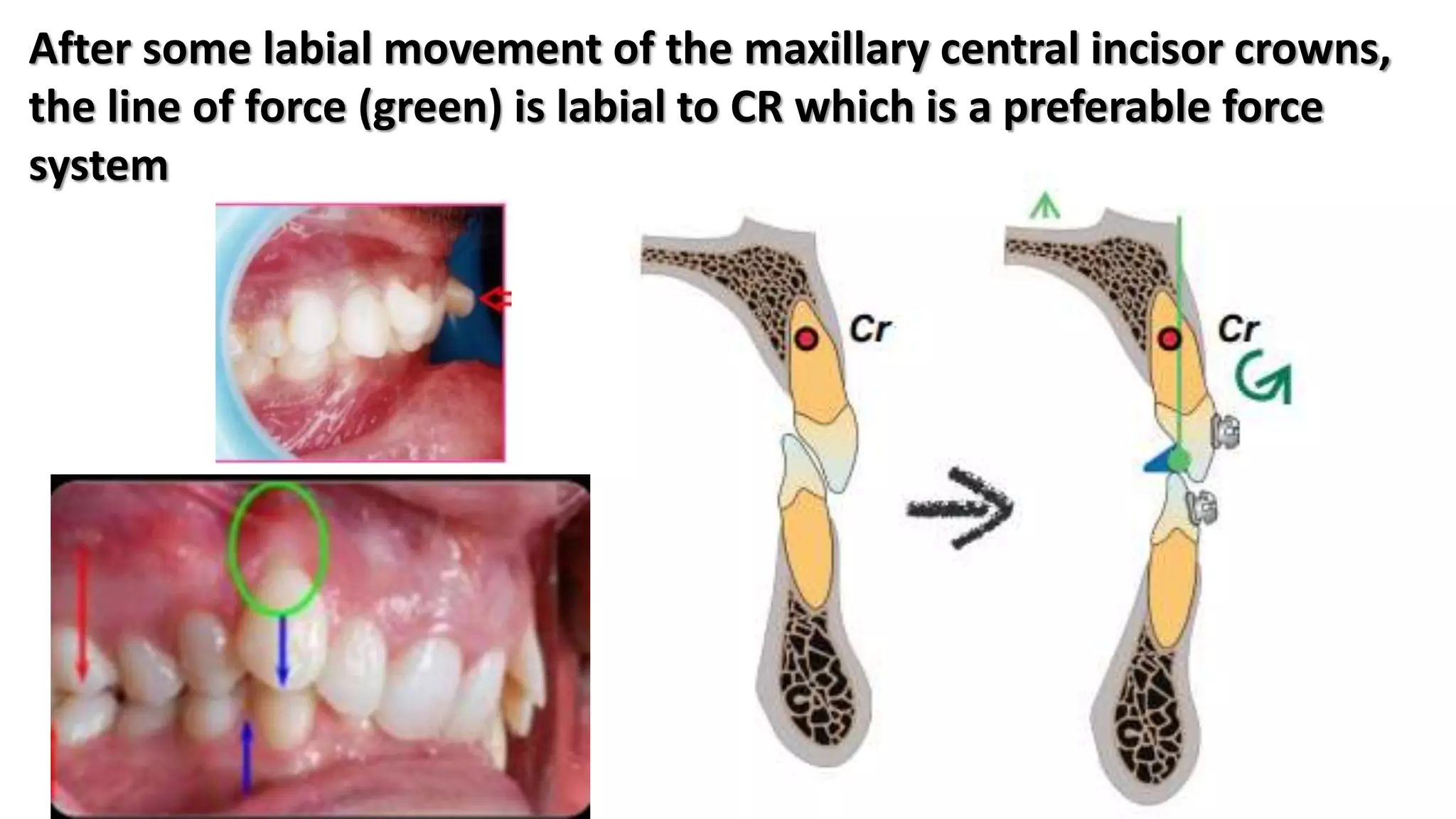 1 opening the bite with bite turbo | PPTX