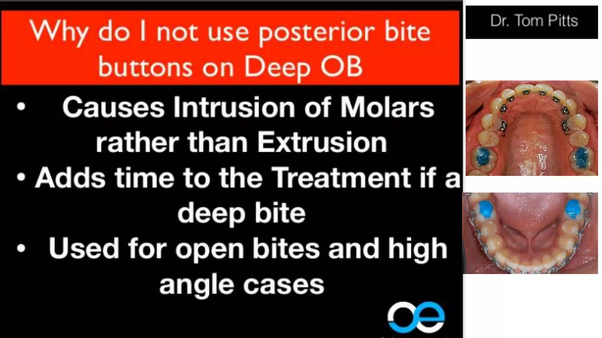 1 opening the bite with bite turbo | PPTX