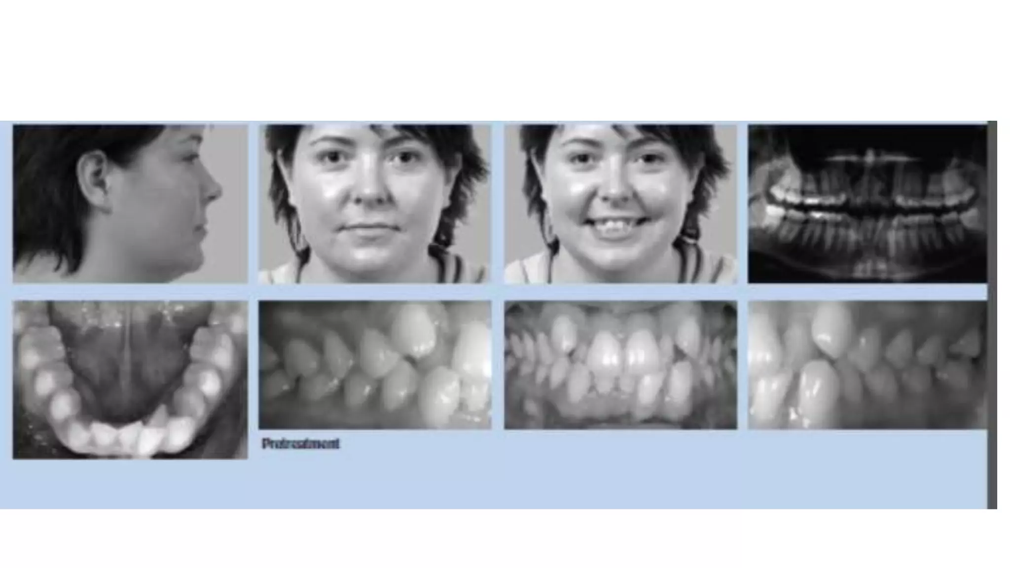 1 opening the bite with bite turbo | PPTX