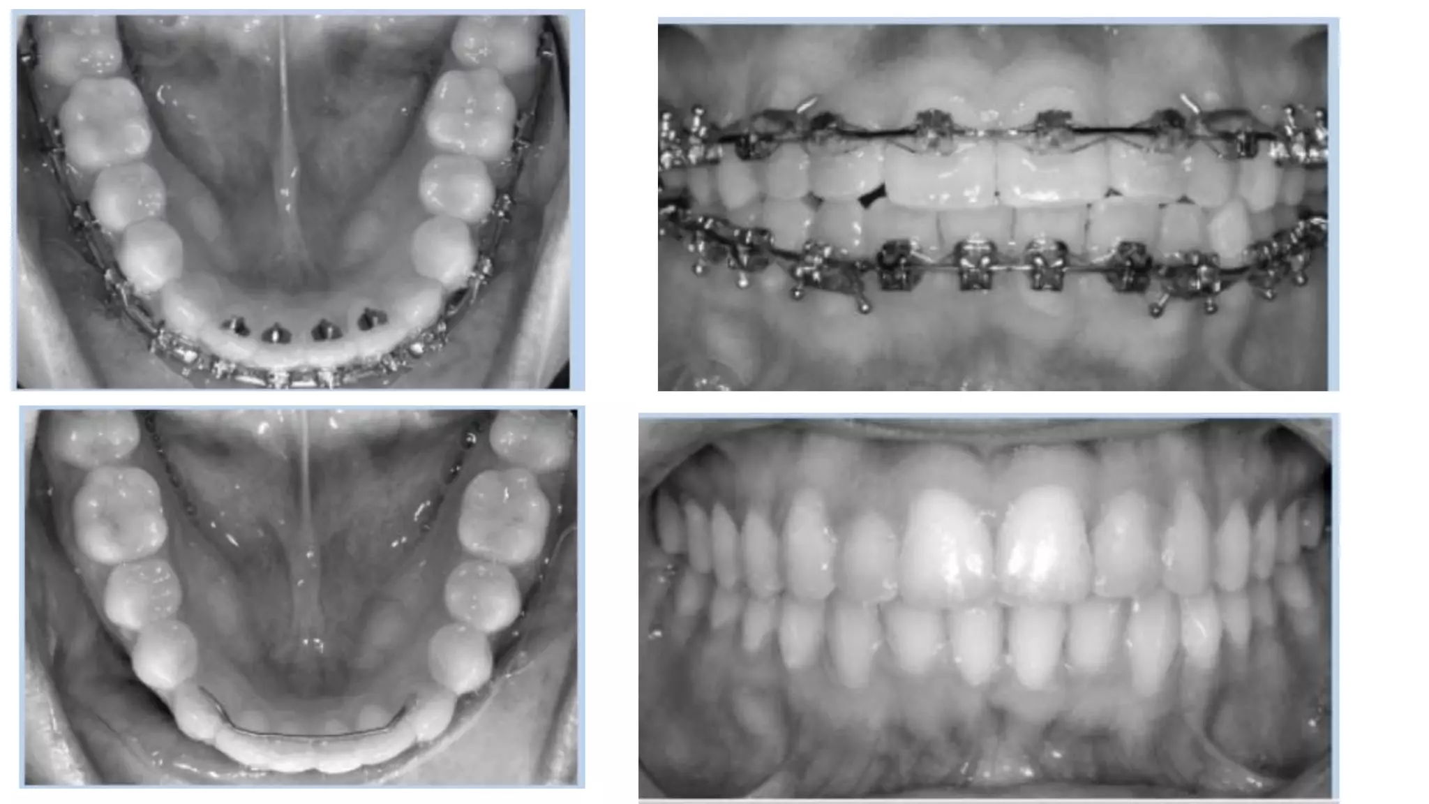 1 opening the bite with bite turbo | PPTX