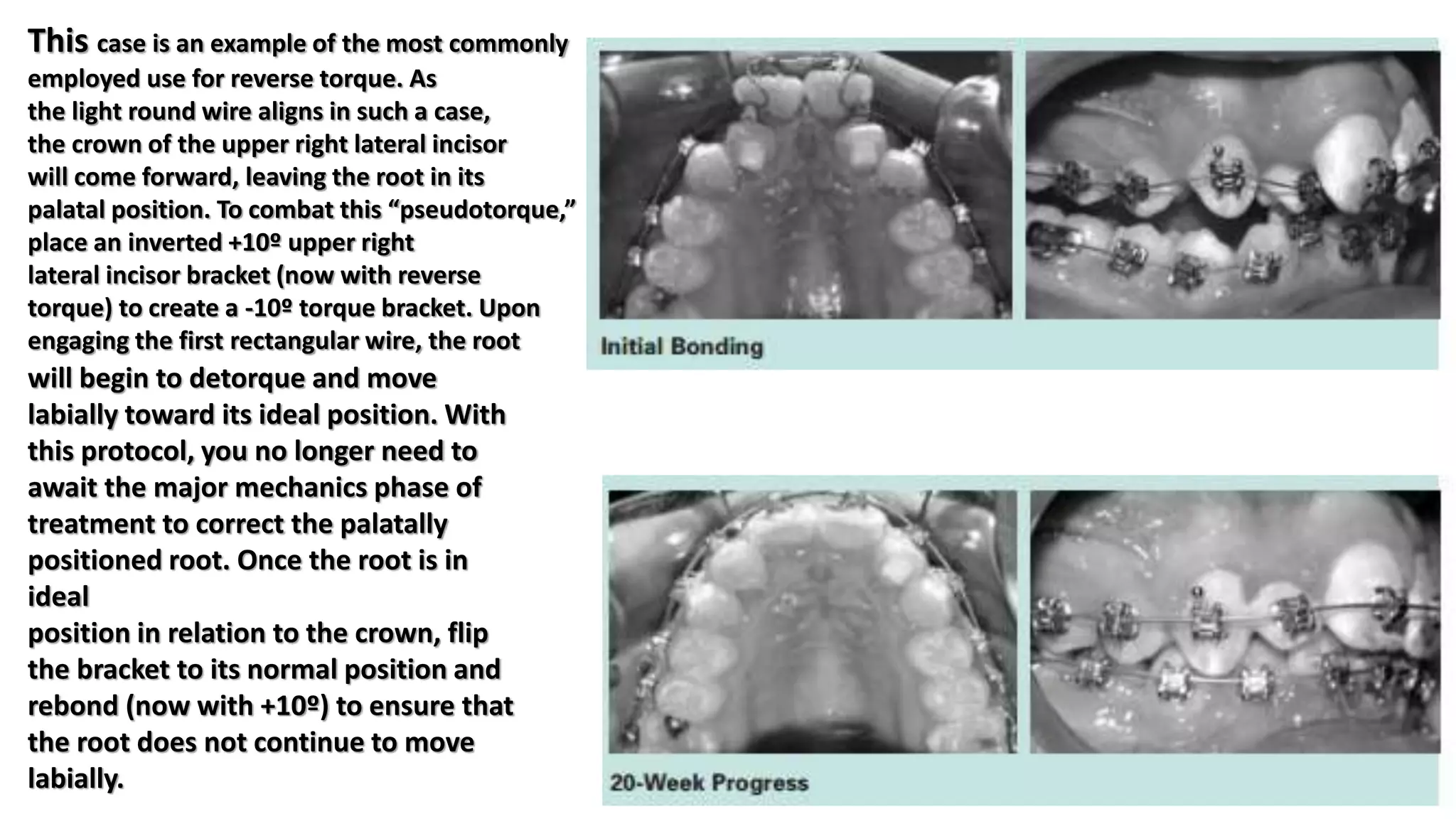 1 opening the bite with bite turbo | PPTX