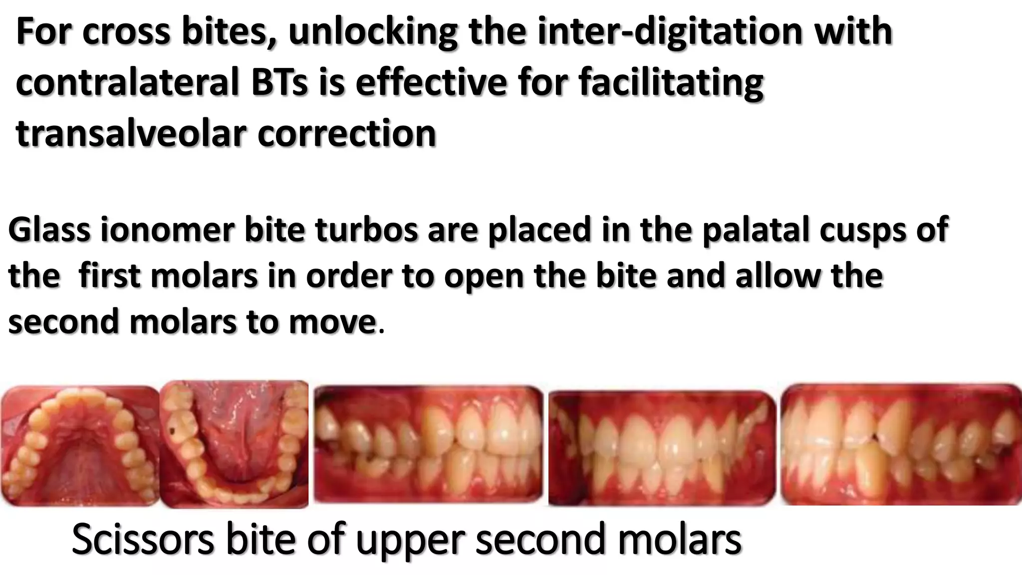 1 opening the bite with bite turbo | PPTX