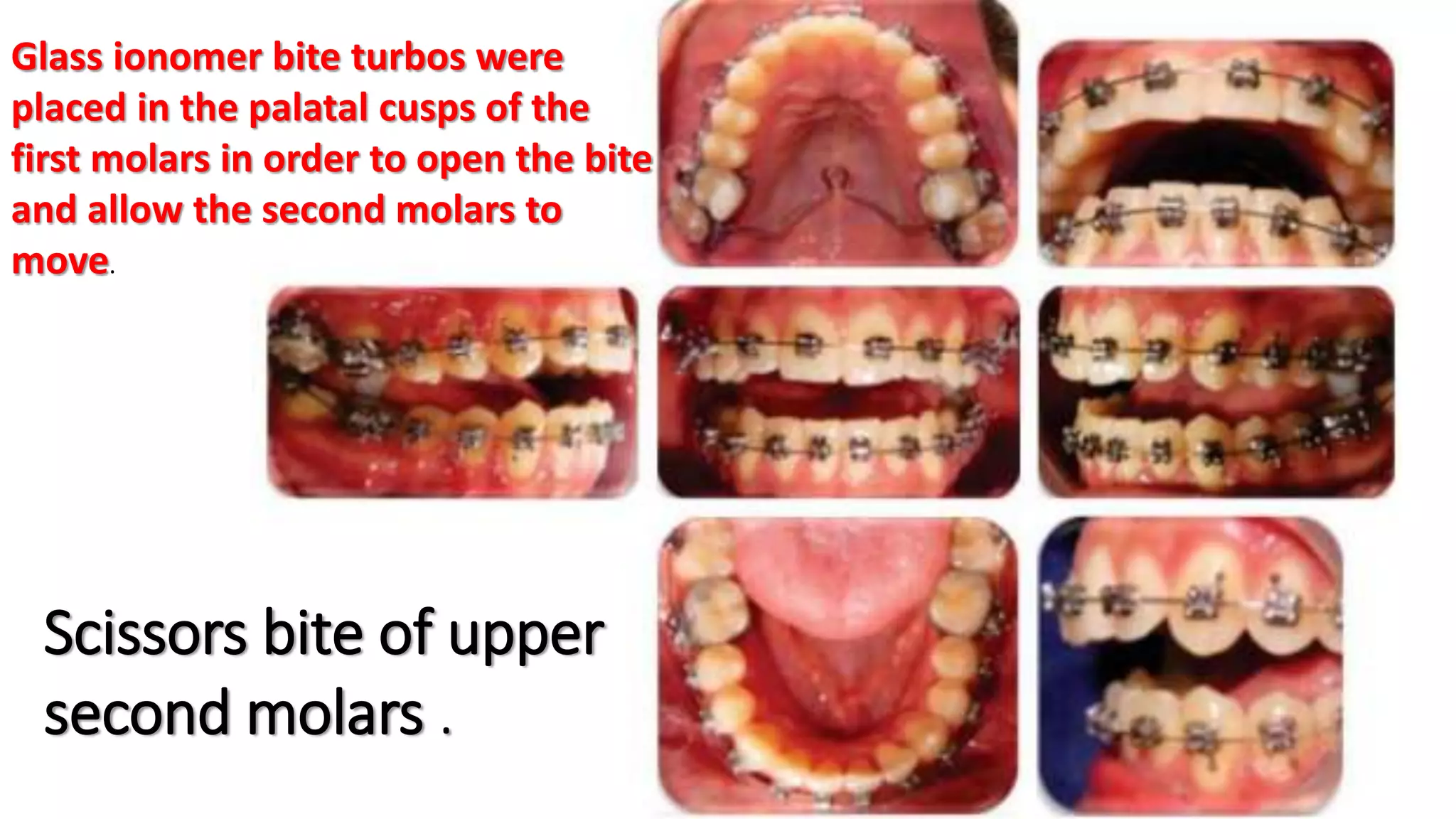 1 opening the bite with bite turbo | PPTX