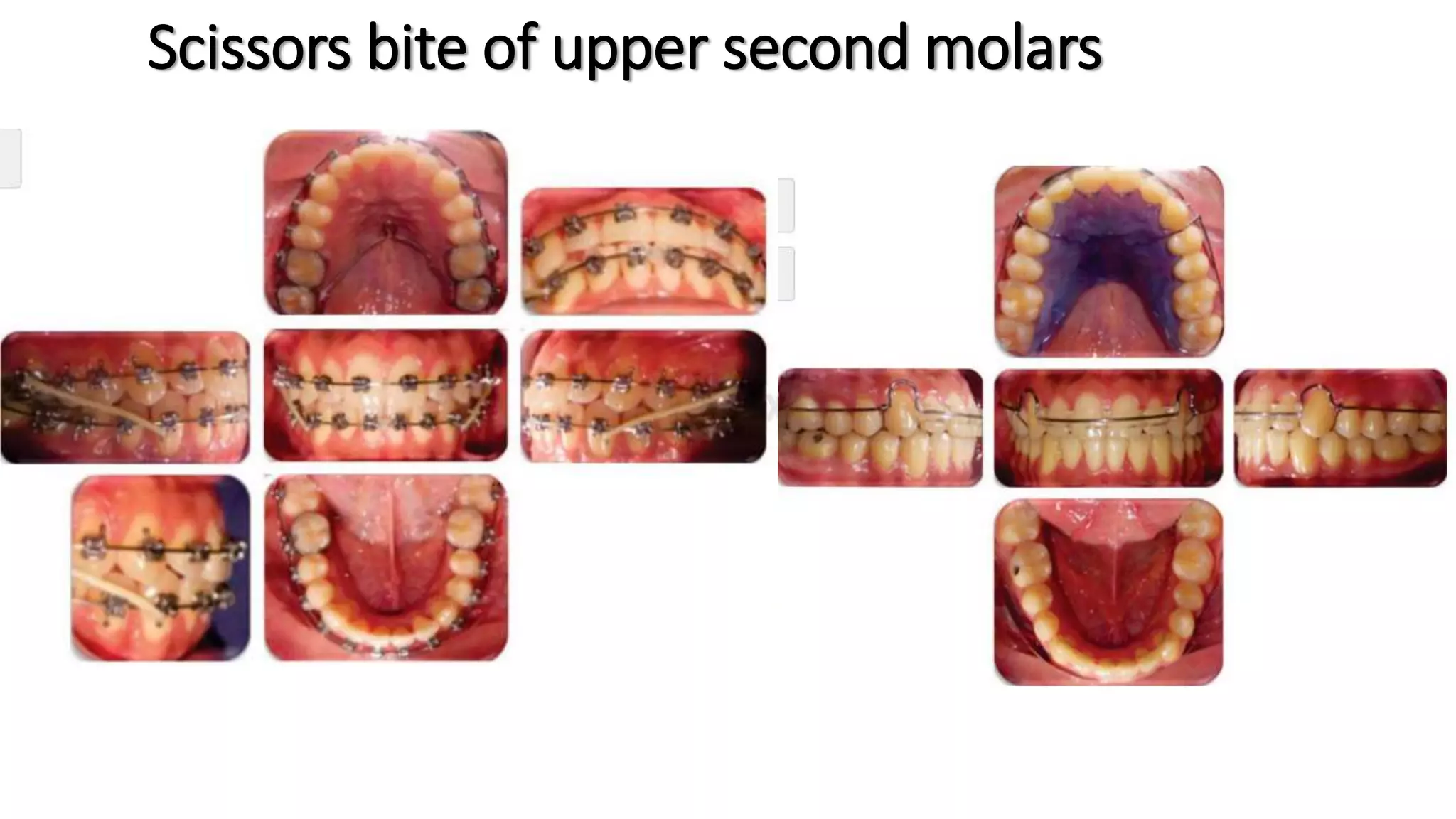 1 opening the bite with bite turbo | PPTX