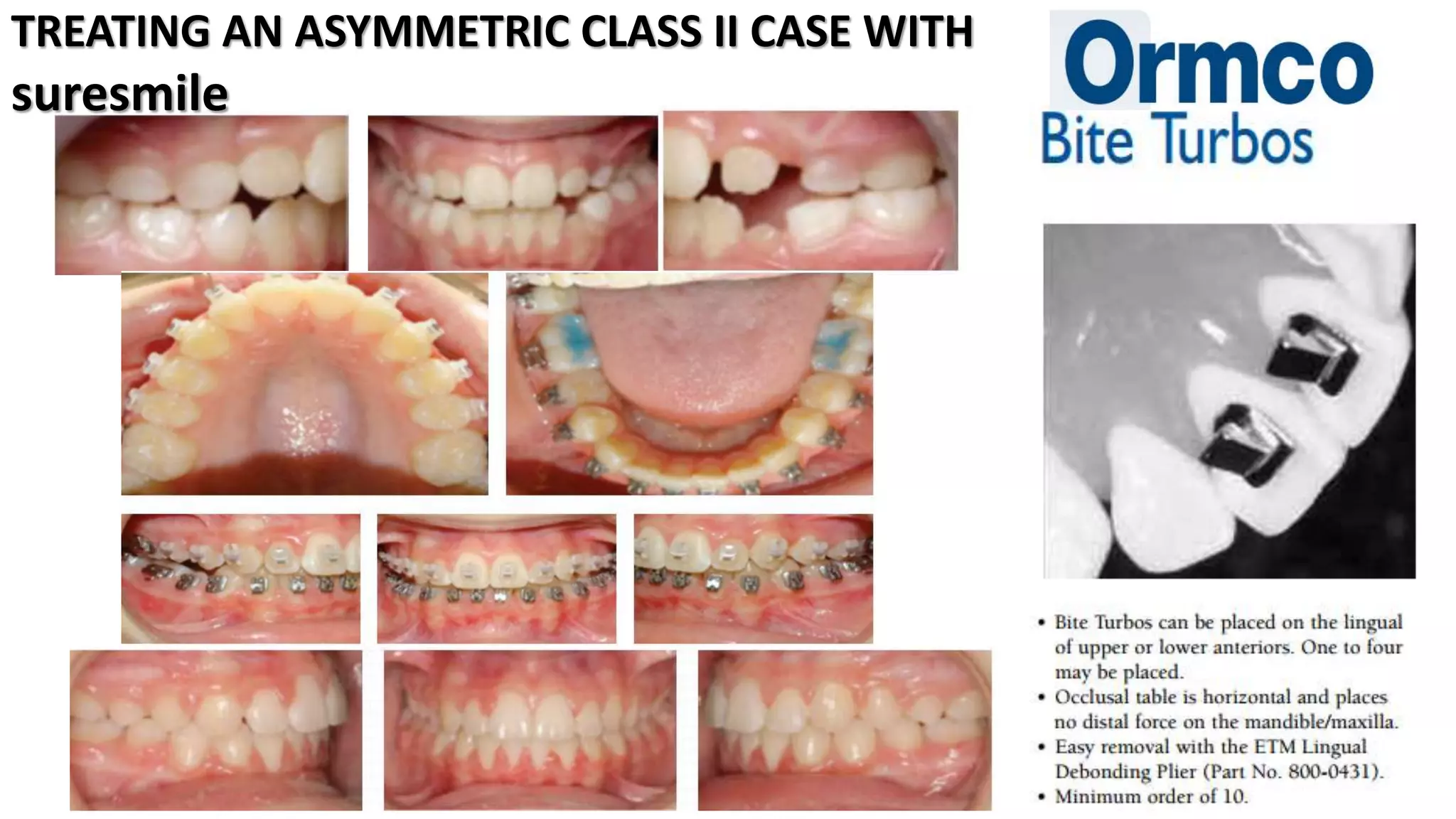 1 opening the bite with bite turbo | PPTX