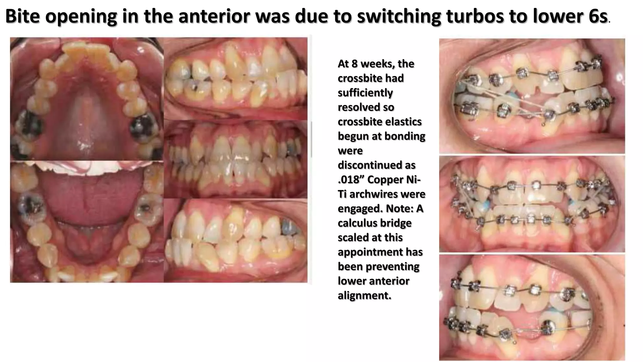 1 Opening The Bite With Bite Turbo Pptx