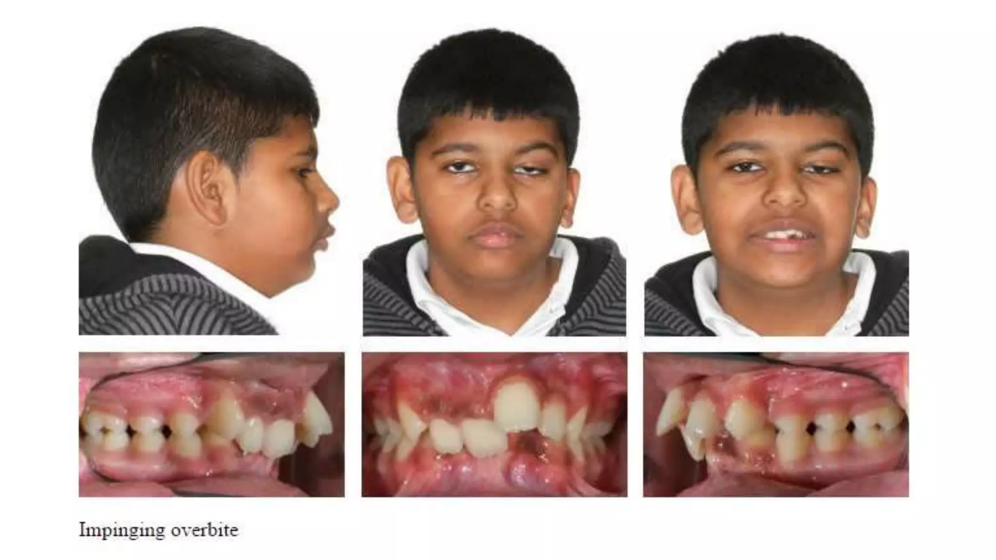 1 opening the bite with bite turbo | PPTX