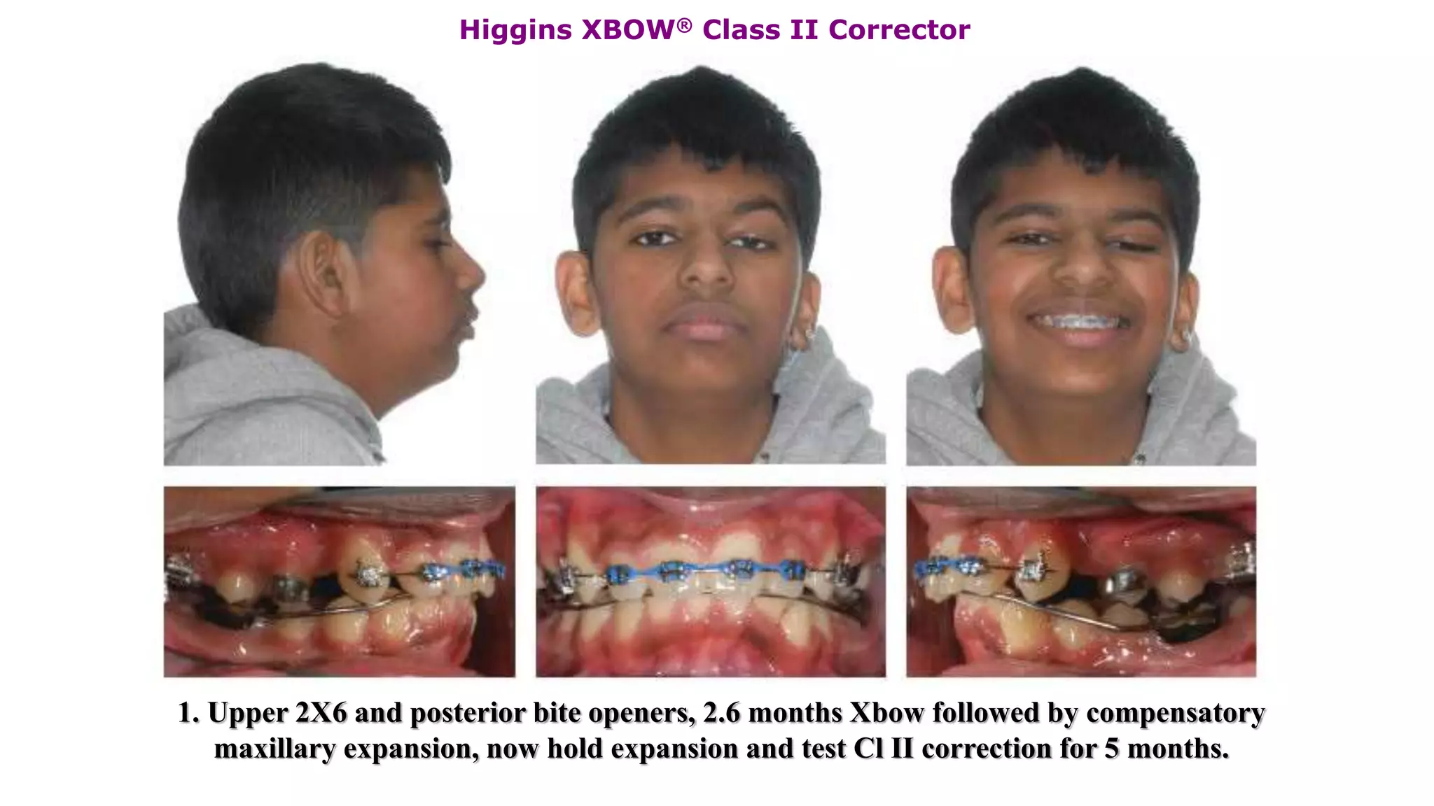 1 opening the bite with bite turbo | PPTX