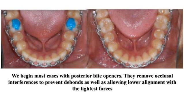 1 opening the bite with bite turbo | PPT