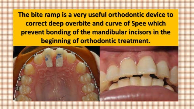 1 opening the bite with bite turbo | PPTX