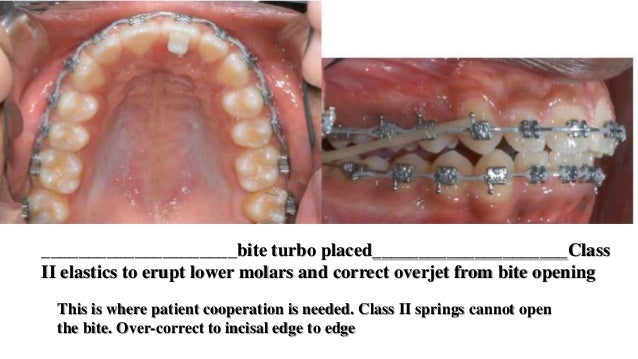 1 opening the bite with bite turbo
