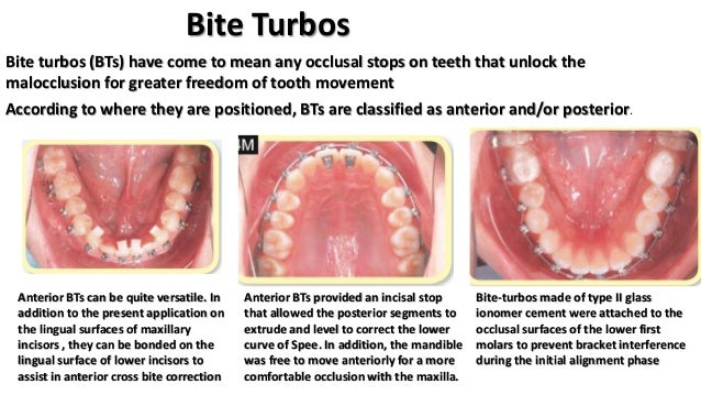 1 opening the bite with bite turbo