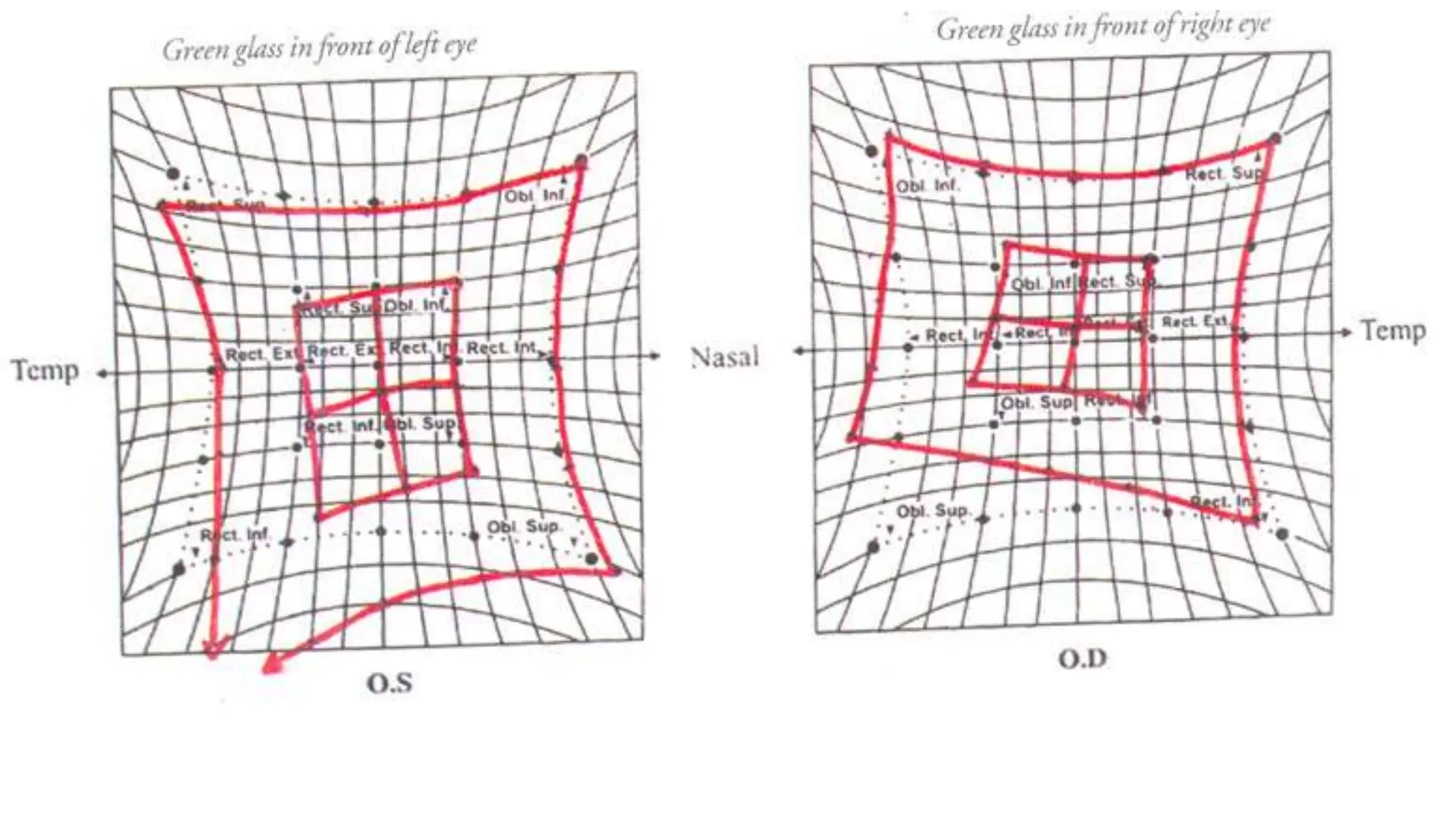 Diplopia_Chart_and_Hess_Chart.pptx