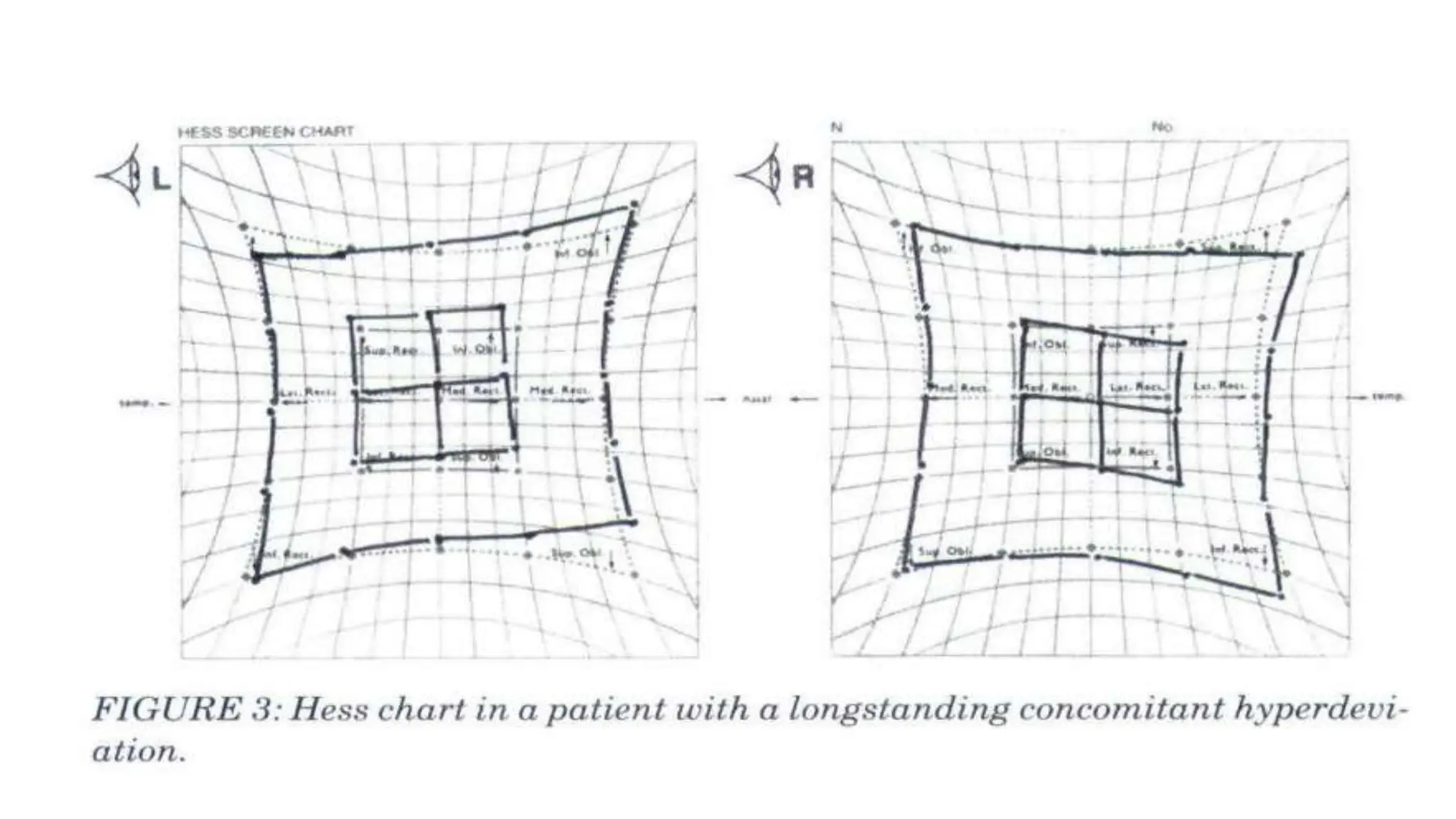 Diplopia_Chart_and_Hess_Chart.pptx