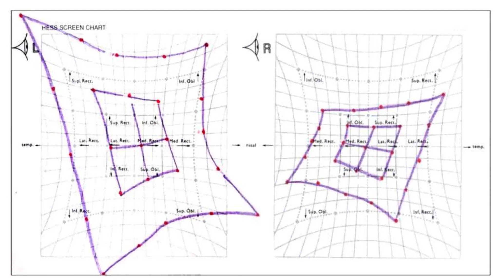 Diplopia_Chart_and_Hess_Chart.pptx