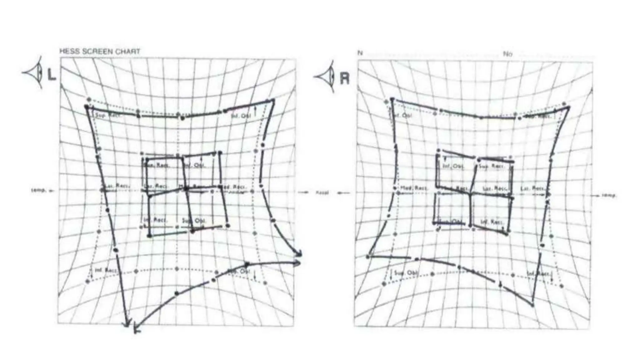 Diplopia_Chart_and_Hess_Chart.pptx