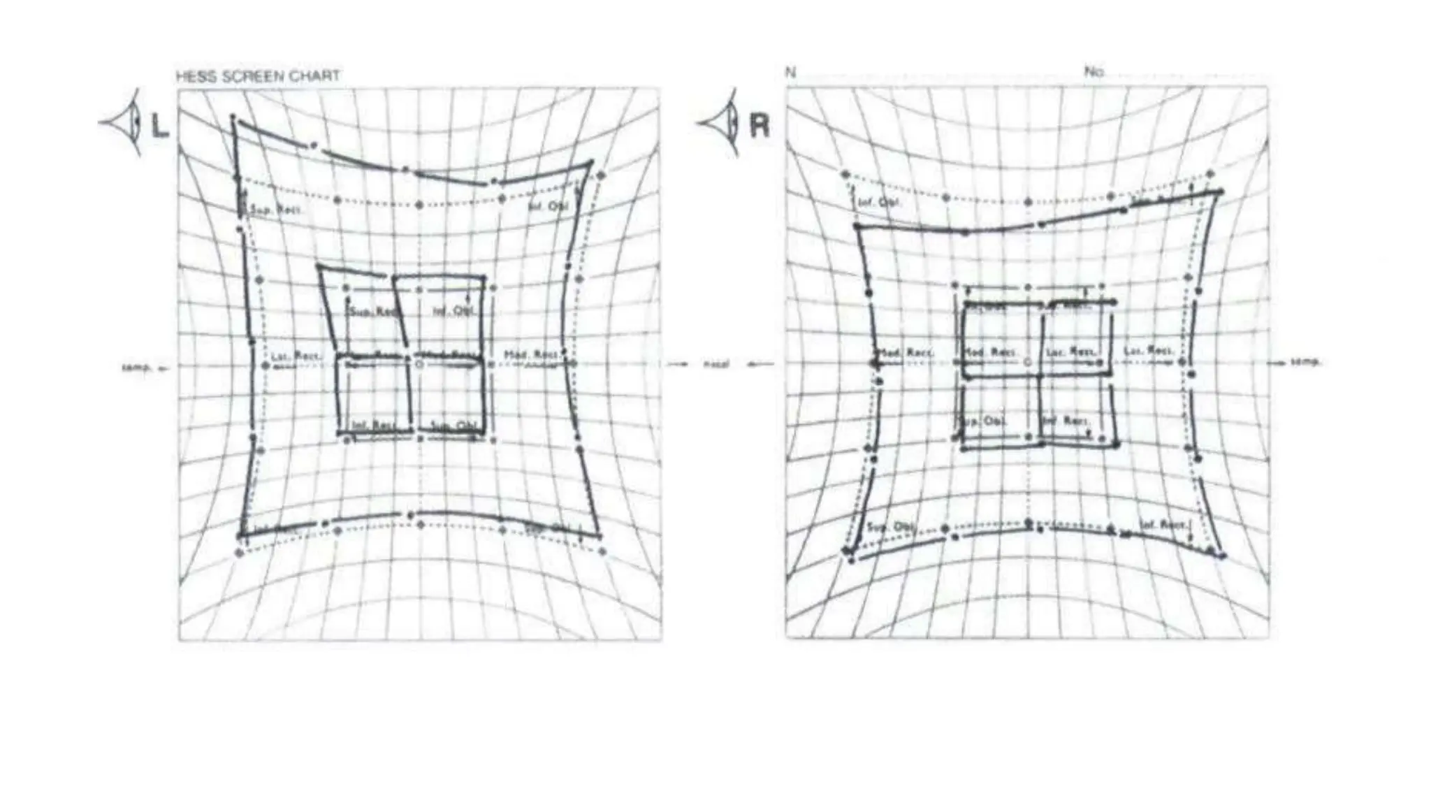 Diplopia_Chart_and_Hess_Chart.pptx