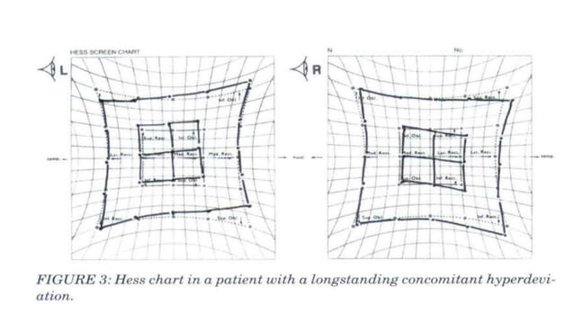 Diplopia_Chart_and_Hess_Chart.pptx