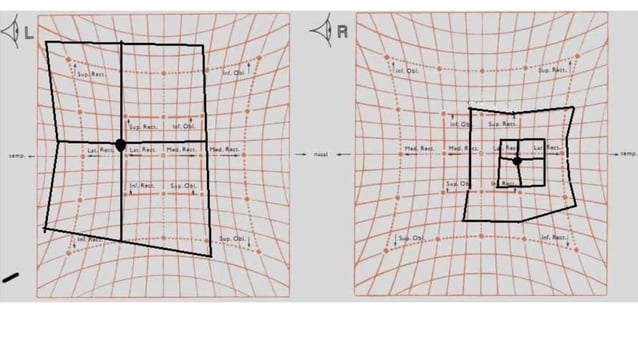 Diplopia_Chart_and_Hess_Chart.pptx