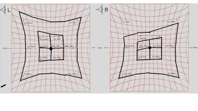 Diplopia_Chart_and_Hess_Chart.pptx