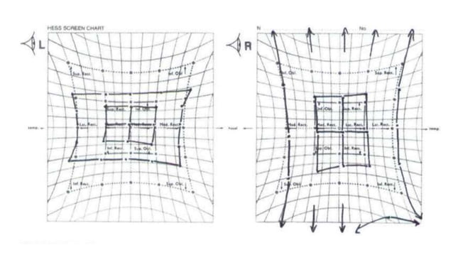 Diplopia_Chart_and_Hess_Chart.pptx