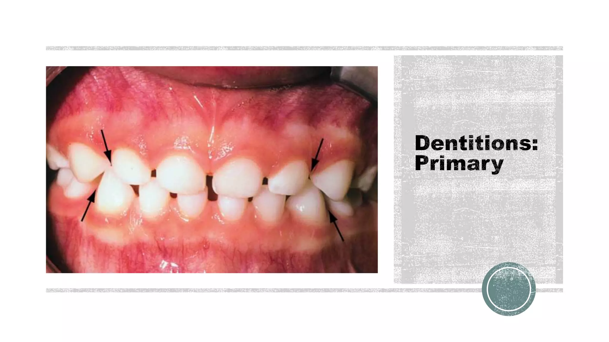 Overview of Dentitions | PPTX