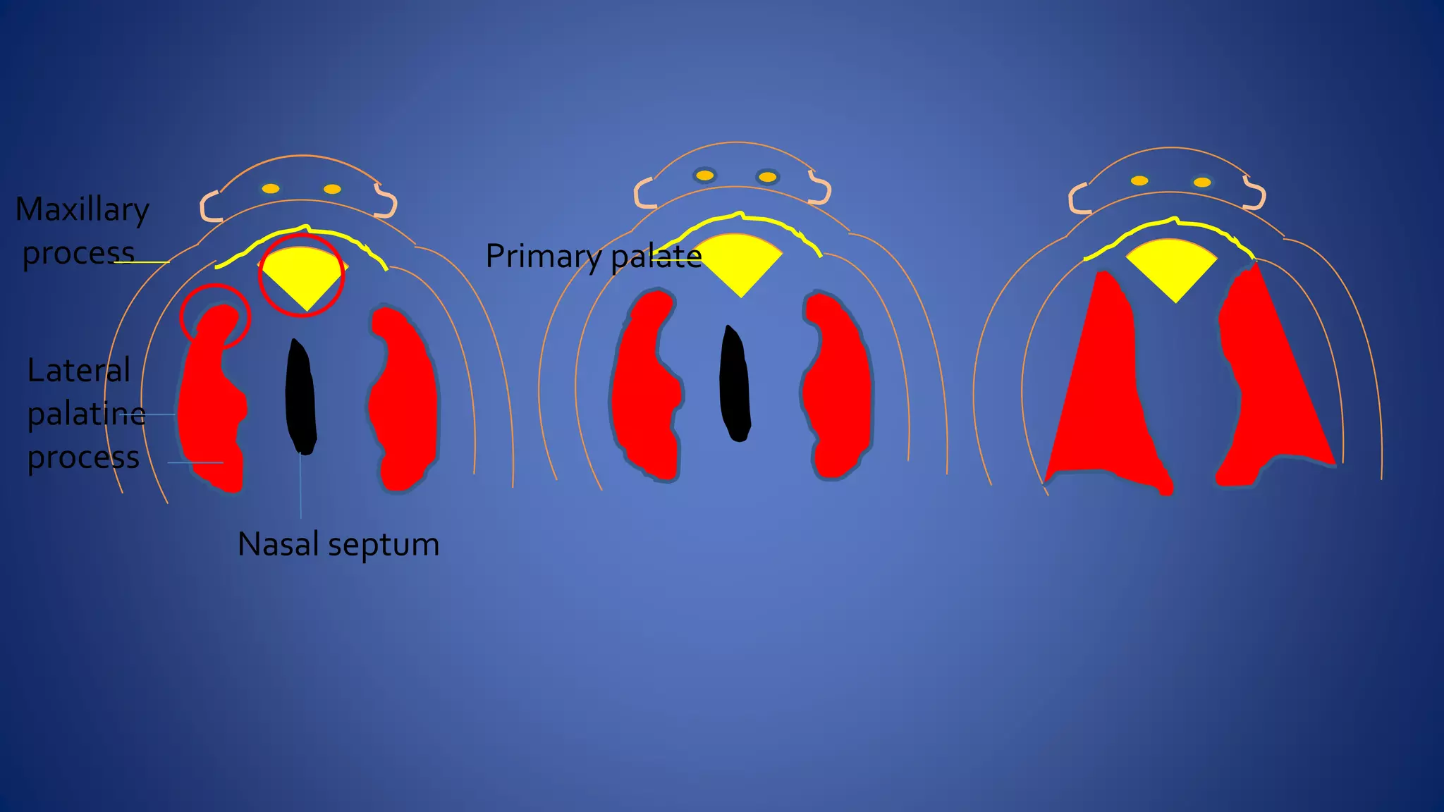 DEVELOPMENT OF PALATE AND ITS ANOMALIES | PPTX