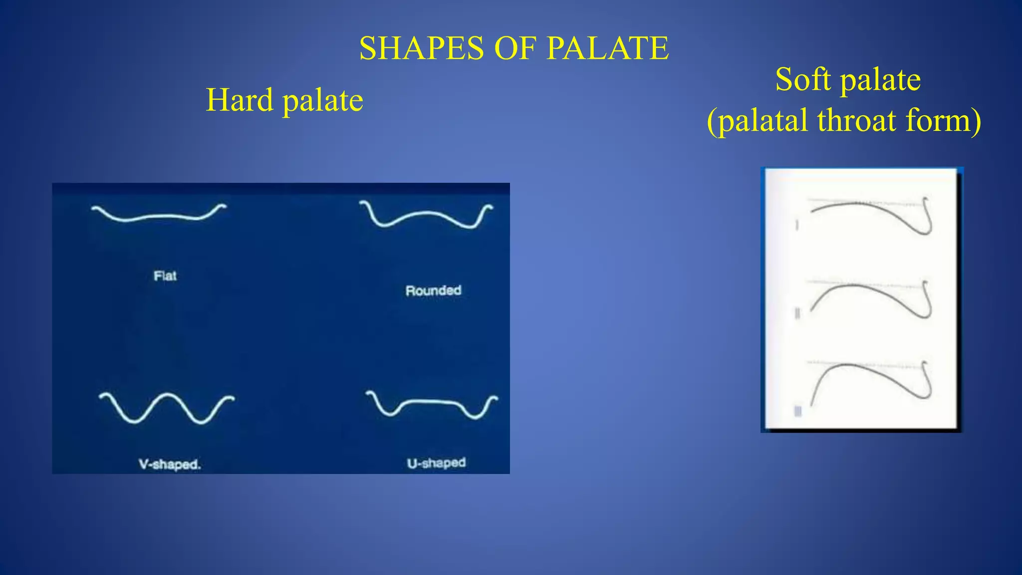 DEVELOPMENT OF PALATE AND ITS ANOMALIES | PPTX
